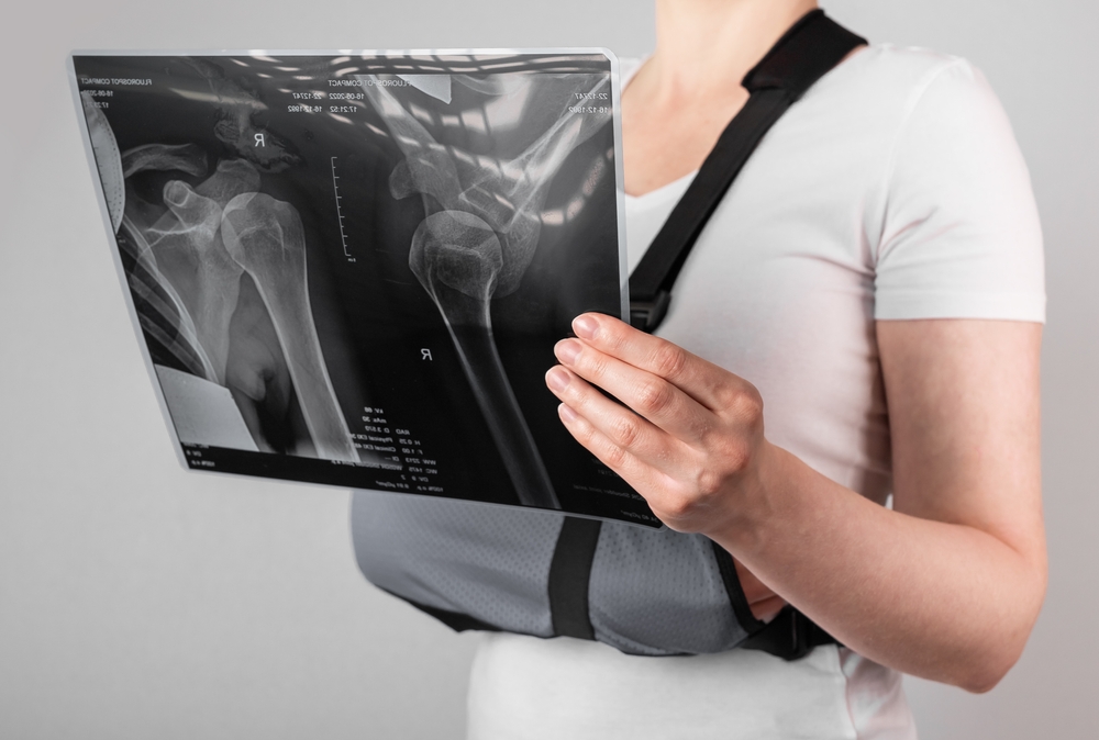 Joint and Dislocation Injuries — Buffalo Personal Injury Lawyer News ...